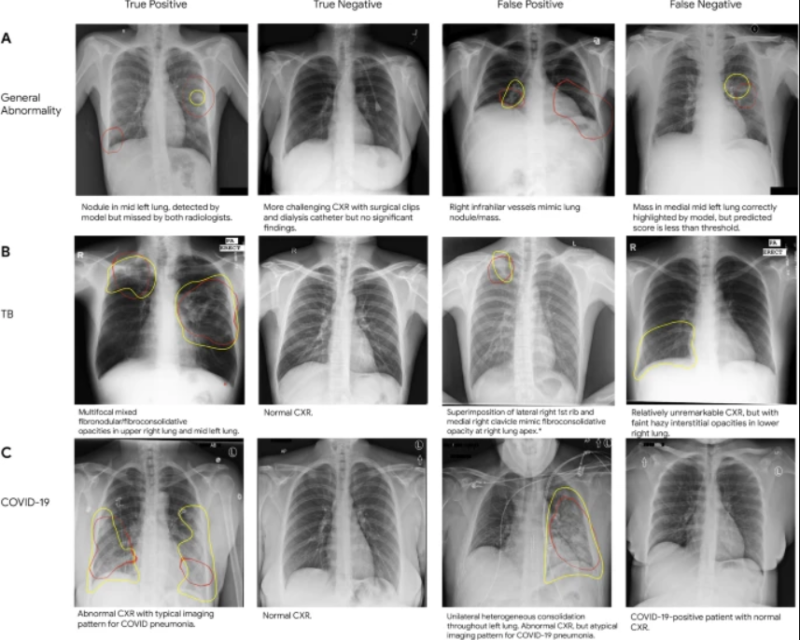 Google’s New Deep Learning System To Distinguish Abnormal Chest Radiographs